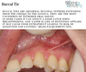 Types of Ties (Including Pictures) - Tongue Tie Life